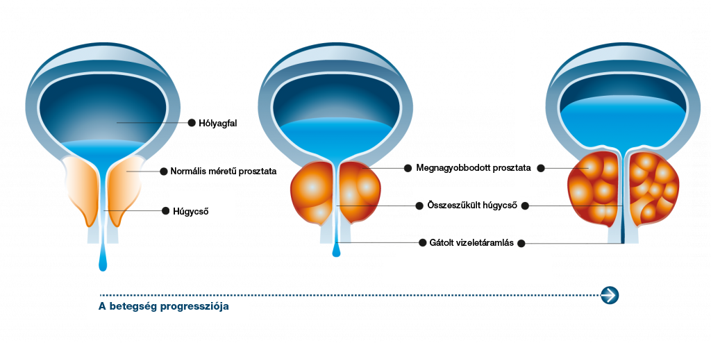 BPH – a tipikus férfibaj | Urostemol