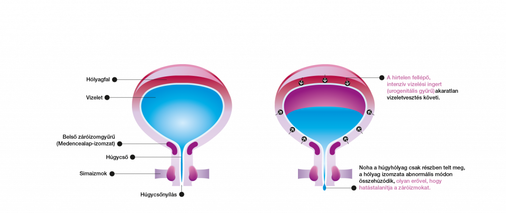 A hiperaktív hólyag | Urostemol