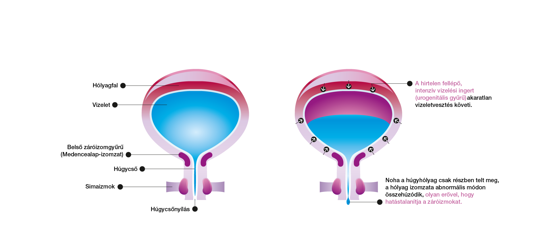 A hiperaktív hólyag | Urostemol